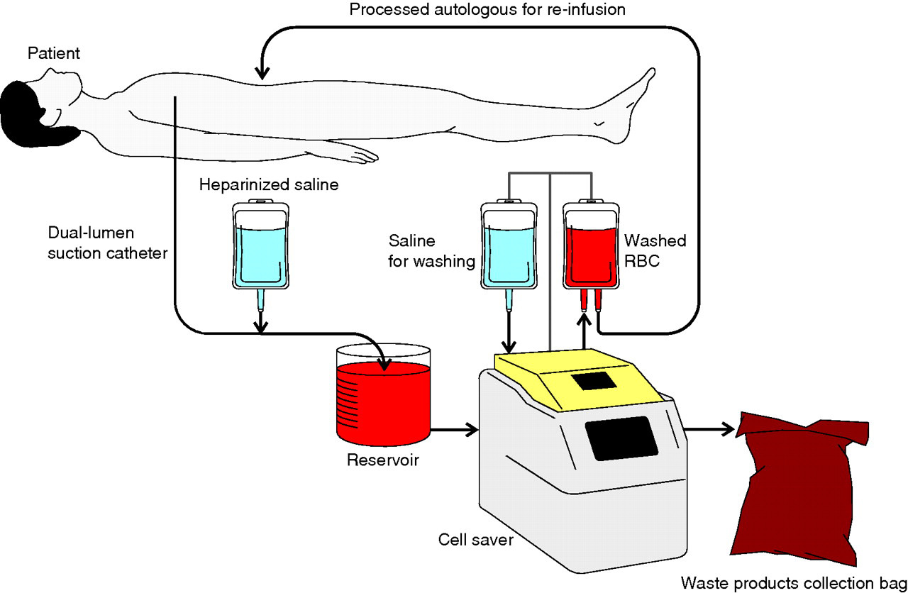 Cell-Saver : principes de base ⋆ Mon Bloc Opératoire